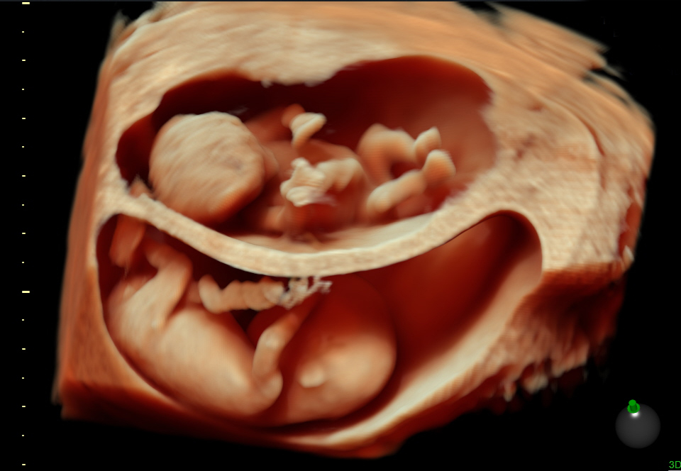 Embarazo Múltiple ¿gemelos, mellizos, trillizos o más?