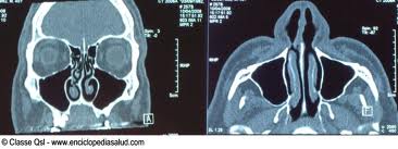 Tomografía de senos paranasales