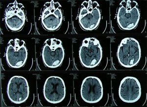 Tomografía computarizada de los senos paranasales