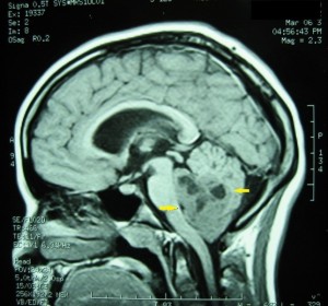 Neuroblastoma cáncer infantil